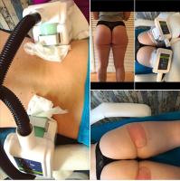 China Supersonic  Fat Freeze Slimming Machine 230vac 50hz 1500w for sale