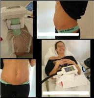 China No Downtime 3 Handles Sincoheren Cool Body Sculpting Machine for sale