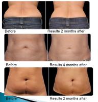 China Reduce Body Sincoheren Vacuum Cavitation Slimming Machine for sale