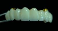 China All On 4 Hybrid Bridge China Dental Lab Full Zirconia Bridge Over Titanium Bar for sale