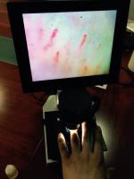 China Magnification 400 Times Digital Microcirculation Microscope Nailfold Microcirculation Equipment for sale