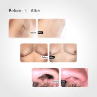 China Diode laser hair removal for sale