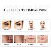 China 1470nm Fractional Laser for Acne Treatment and Laser Wrinkle Removal Beauty System for sale