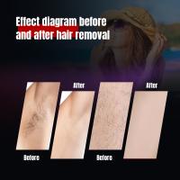 China 755nm High Power Alexandrite Laser Hair Removal Machine for Commercial Applications for sale