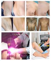 China Permanent Platinum Ice Diode Laser Hair Removal Machine with 12*12mm Spot Size by HUAMEI for sale