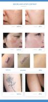 China Multi Colors 2024 Portable Carbon Peel Nd Yag Laser Tattoo Removal Machine for Salon for sale