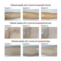 China Salon Diode Laser Hair Removal Machine with CE TUV ISO Certification and Triple Wave Ice for sale