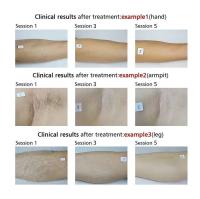 China 12*12mm Titanium 808nm Diodo Laser Hair Removal Machine with Advanced Cooling System for sale