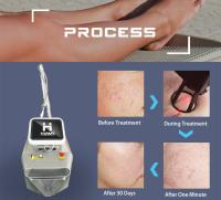 China 15W 30W Optional Co2 Fractional Laser Co2 Laser Portable Stretch Mark Removal Machine for sale
