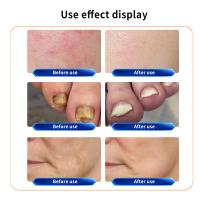 China Portable 980nm Diode Laser for Quick Spider Vein Removal Vascular Treatment by Huamei for sale