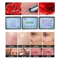 China 980nm Diode Laser Fungus Nail Treatment Machine with Air Semiconductor Cooling System for sale