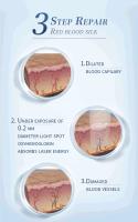 China Multi-functional 980nm Diode Laser for Vascular Lesion Removal and Skin Rejuvenation for sale