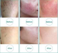 China Say Goodbye to Vascular and Nail Fungus with Diode Laser 980 Aesthetic Spa Equipment for sale