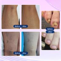 China PORTABLE 980nm Diode Laser Spider Vascular Removal Machine Multi-language User Manual for sale