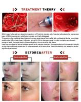 China Highly Effective 980nm Diode Laser for Skin Fungal Infection Vascular Veins Removal for sale