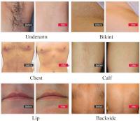 China 12*35mm Spot Size 808nm Diode Hair Removal Laser Diodo Beauty Machine with Materials for sale