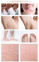 China Advanced 808nm Diode Laser Hair Removal Machine with Germany/USA Bar and NO Q-Switch for sale