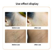 China Effective Stationary Hair Removal Machine with Titanium 3 Wavelength 808nm Diode Laser for sale