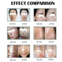 China STANDING 2023 5 IN 1 Skin Resurfacing Skin Tightening Machine with Needle 64 needles for sale