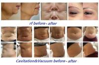 China Body Targeted Weight Loss 2023 Portable Vacuum Cavitation Radiofrequency and Cavitation/RF Frequency Machine for sale