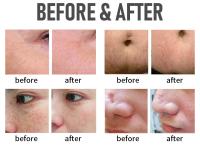 China Legs/Arms Targeted Professional C02 Laser for Vaginal Tightening and Skin Resurfacing for sale