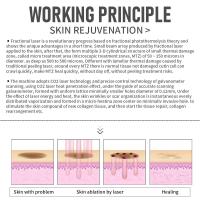 China Fractional CO2 Laser Machine for Professional Skin Resurfacing and Wrinkle Removal for sale