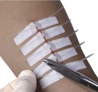 China Self Adhesive Dermaclip Stitches Alternative Suture For Skin Closure Non Invasive for sale