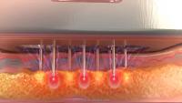 China Safe And Precise Fractional RF Microneedling Machine For Skin Rejuvenation And Tightening for sale