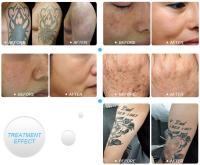 China 532nm 1064nm Picosecond Laser Tattoo Removal Machine Nd Yag for sale