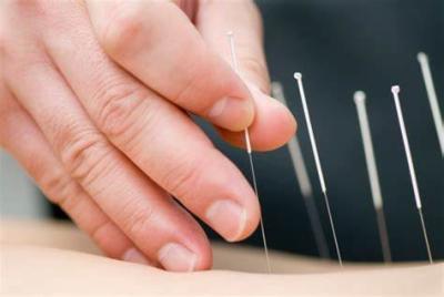 China Customizable Stainless Steel Disposable Acupuncture Needles With Guide Tube for sale