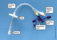 China Medical Silicone Gastrostomy Feeding Tube PEG For Percutaneous Endoscopic Gastrostomy Different Sizes for sale