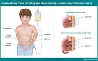 China Medical Silicone Gastrostomy Feeding Tube PEG For Percutaneous Endoscopic Gastrostomy Different Sizes for sale