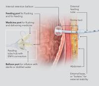 China Medical Silicone Gastrostomy Feeding Tube PEG For Percutaneous Endoscopic Gastrostomy Different Sizes for sale