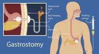 China Medical Silicone Gastrostomy Feeding Tube PEG For Percutaneous Endoscopic Gastrostomy Different Sizes for sale