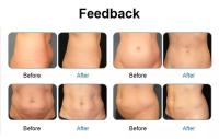 China 532nm 635nm Lipo Laser Slimming Machine Weight Loss 6d Green Red Light Laser for sale