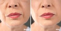 China Professional 40.68Mhz Rf Face Lifting Machine Wrinkle Remove 40.68Mhz for sale