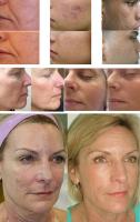 China Rf Microneedle Fractional Radio Frequency Machine Face Lift Wrinkle Removal for sale