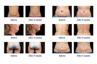 China 5 In 1 3D Cavitation Slimming Machine Ultrasonic Vacuum RF Photon Fat Burning Machine for sale