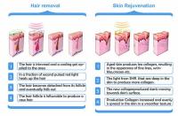 China PicoSecond Laser 532nm 755nm IPL beayty Machine For Treatment Pigmentary for sale