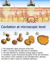 China 32KHZ 80K Ultrasound Cavitation Slimming Machine Tripolar Radio Frequency for sale