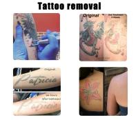 China Portable 532nm 1320nm 1064nm Q Switched Nd Yag Laser Machine Tattoo Removal for sale