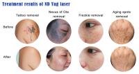 China Nd Yag Q Switched Laser Device Tattoos Removal Machine for sale