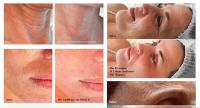 China LDM Ultrasound Skin Rejuvenation Machine Low Frequency Dual Frequency for sale