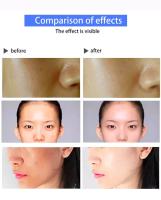 China 3 In 1 Acne Removal Eyelid Face Plexer Plasma Jett Skin Lifting Machine Cold And Hot Therapy Radio Frequency for sale