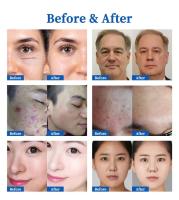 China Anti Acne Spot Freckle Removal Skin Lifting Plasma Pen Double Chin Removal Machine for sale