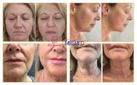 China 7D 12D 14D ICE HIFU Face Lifting Wrinkle Removal HIFU Machine for sale