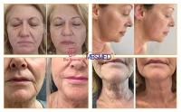 China 2024 Newest Hifu Small Face Lifting Hifu High Intensity Focused  Facial Skin Rejuvenation HIFU Machine for sale