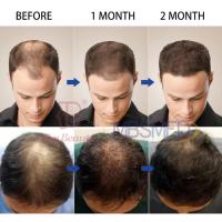 China Tecar Therapy Machine Indiba Radiofrecuency Hair Follicle Health Anti Hair Loss Treatment Hair Growth for sale