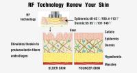 China Face Lifting Ems RF Wrinkle Removal And Skin Lifting Beauty Machine for sale