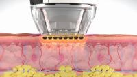 China Rf Power Microneedling Fractional Rf Microneedle Scarlet Device With Vacuum for sale